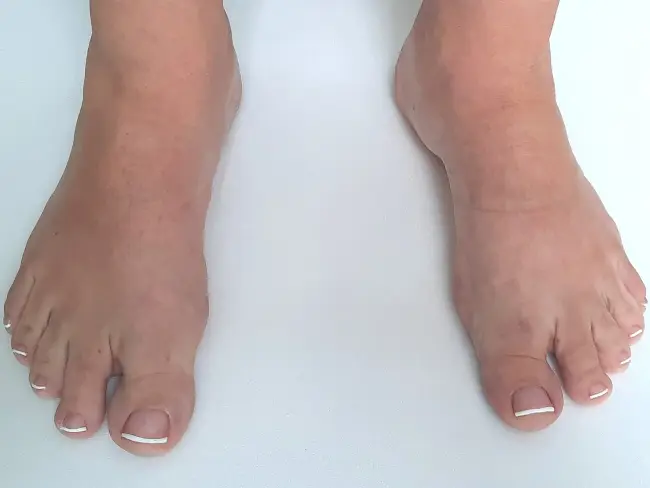 Příčně plochá noha - Estetická chirurgie nohy