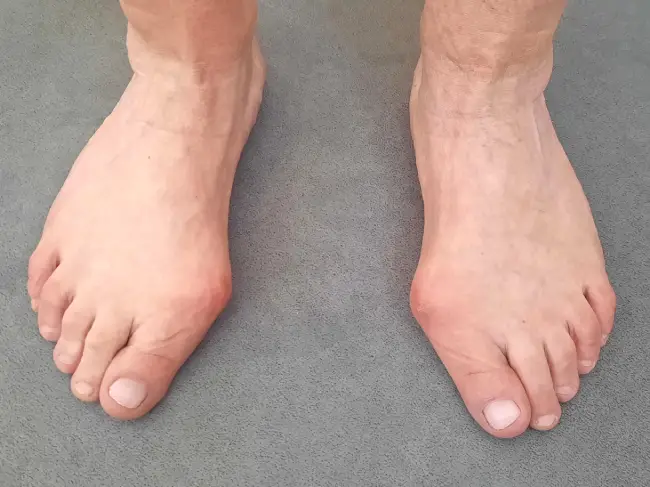 Příčně plochá noha - Estetická chirurgie nohy